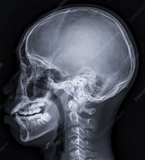 Is It Safe To Xray The Head - My Share