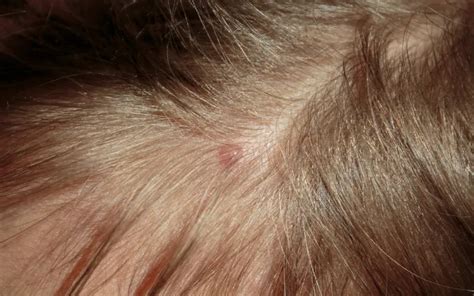 Pimples On Head - My Share